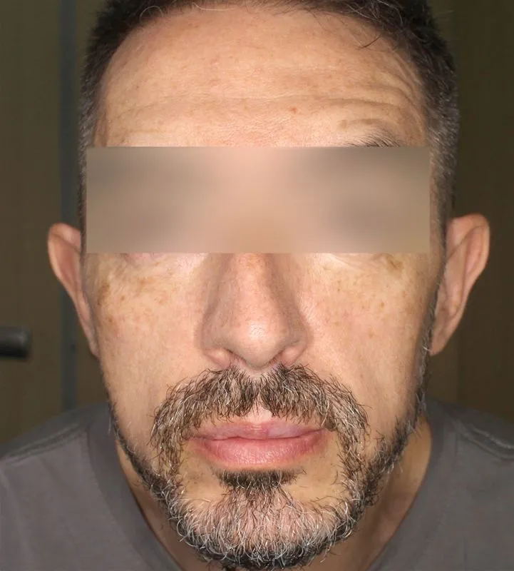 Tratamiento Avanzado de Manchas en la Piel | CanariasDerma