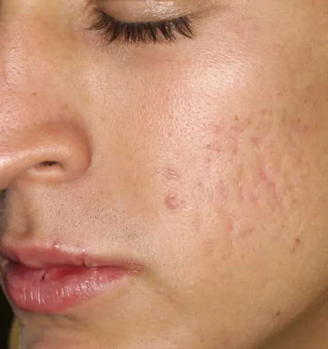 Tratamiento Avanzado de Cicatrices | Especialistas en CanariasDerma