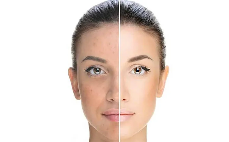 El melasma y el léntigo solar tienen solución para este verano