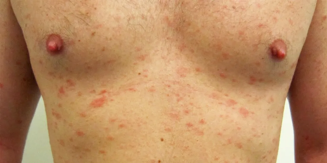 Pitiriasis rosada de Gibert - Canarias Dermatológica